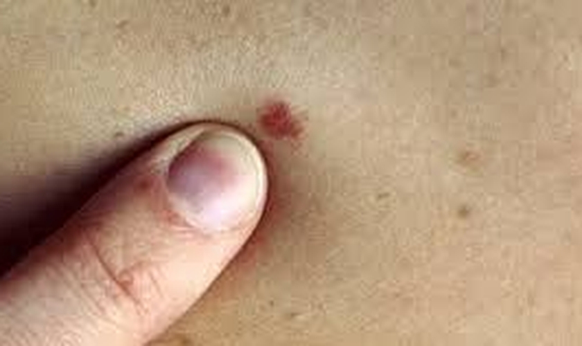 Saiba como identificar uma pinta suspeita - Guiame