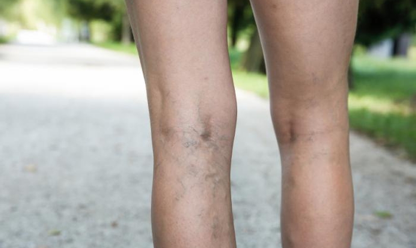 Varizes: conheça as principais causas e efeitos - Guiame