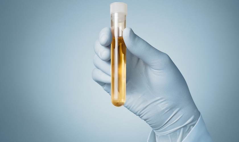 Saiba como a cor da urina pode revelar doenças - Guiame